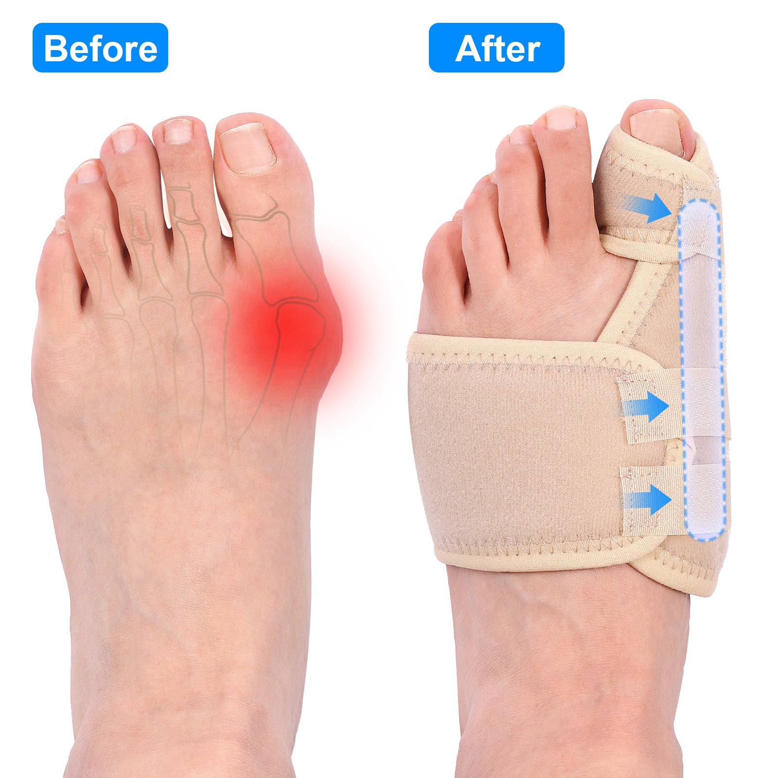 Ankle Wrap for Bunion Correction with Metal Support - Fivali